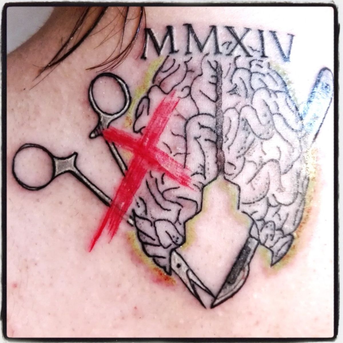 Tattoo uploaded by Lorena/Leo • Tattoo for overcoming a cerebral ...